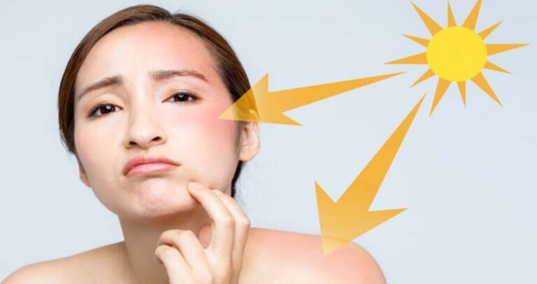 Sun Exposure & Melasma - MELASMA CURE
